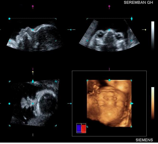 Detecting abnormalities in pregnancy via anomaly scan