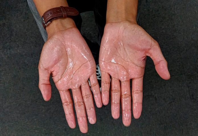 Perpetual torment from excessive sweating